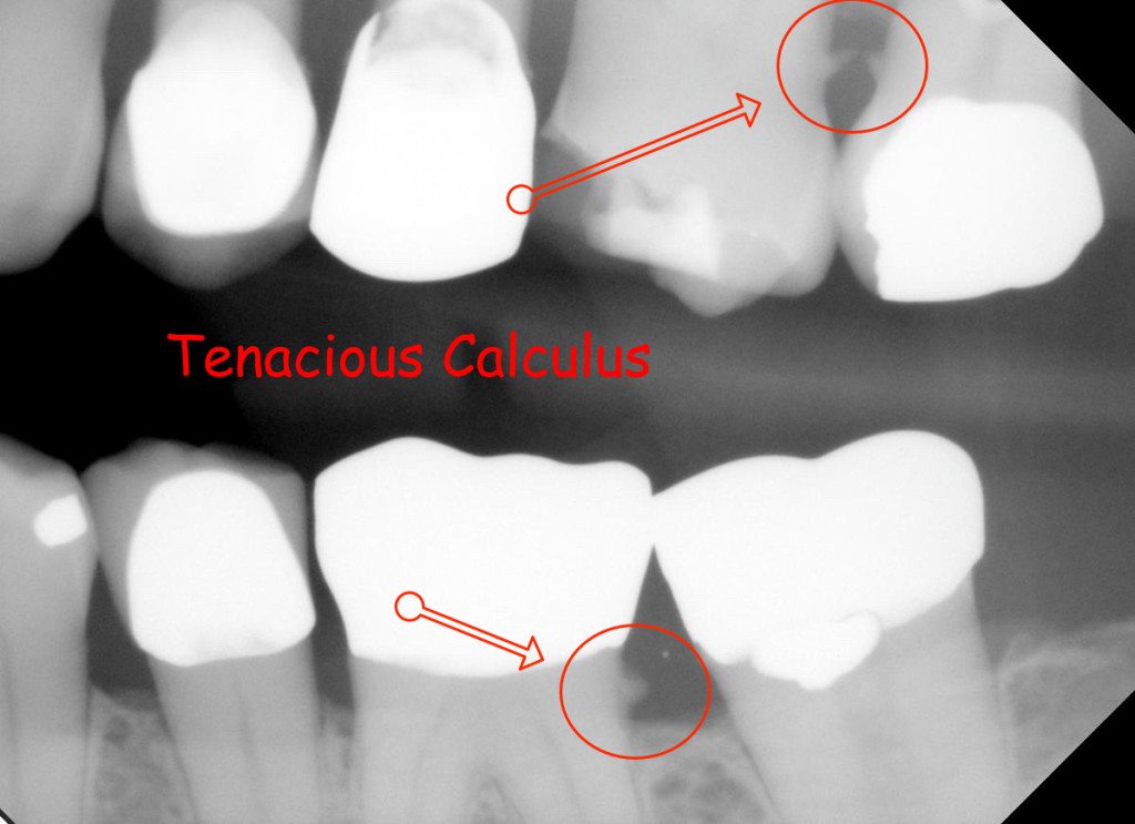 Health Smiles program (before) III - Seasons of Smiles Dental