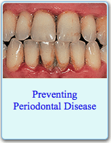 Periodontal (Gum) Disease - Seasons of Smiles Dental